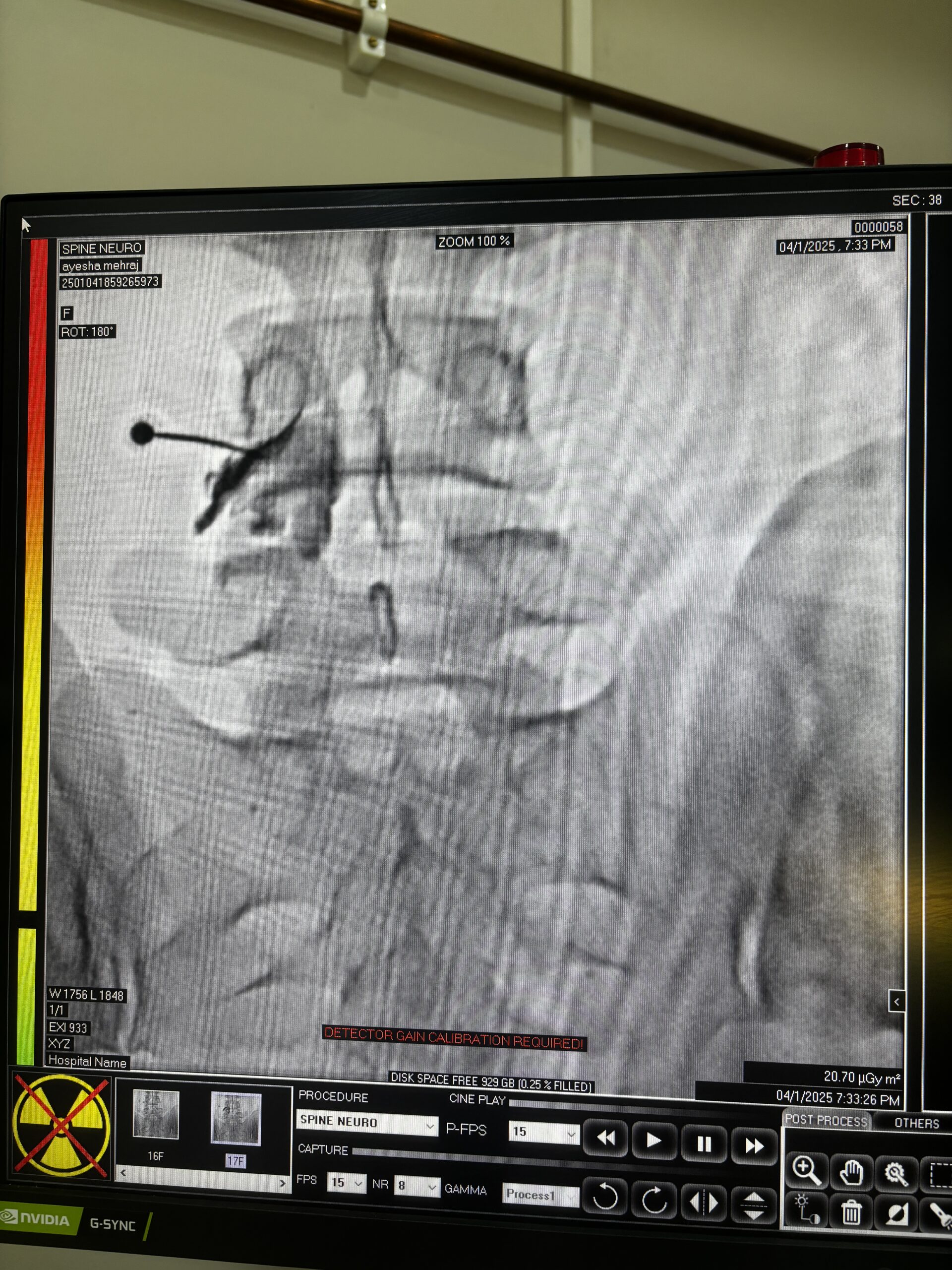 Sciatica - Dandy Brain and Spine